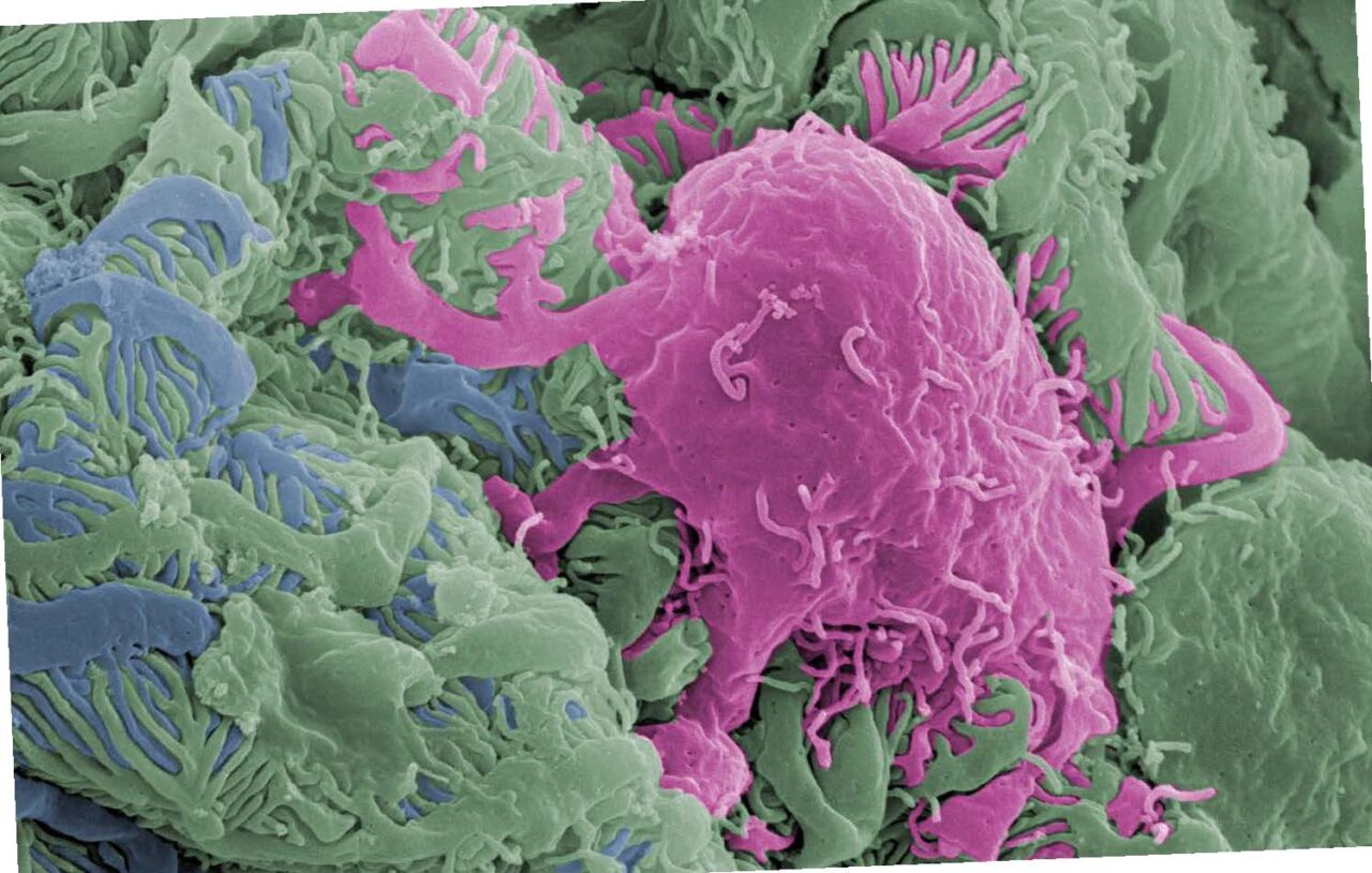 NDT Kidney Art Gallery | ERA